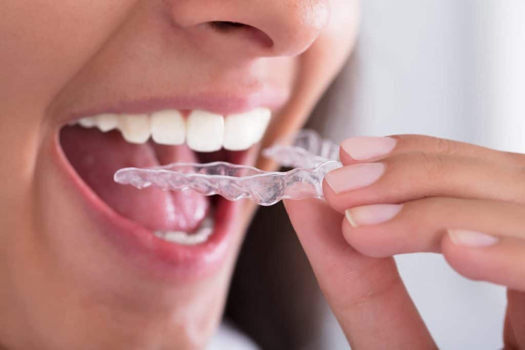 Can Invisalign Fix An Overbite? | Smile Architects